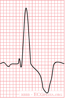 Bestand:RBBB.png - ECGpedia