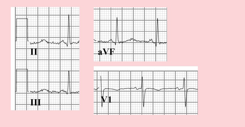 Bestand:NormalSR.jpg - ECGpedia